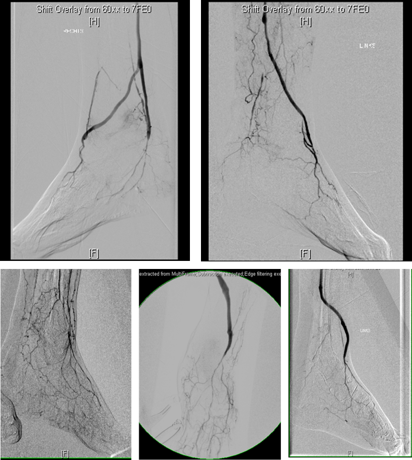 PAVK (Beindurchblutungsstörungen) - Barmherzige Brüder Linz