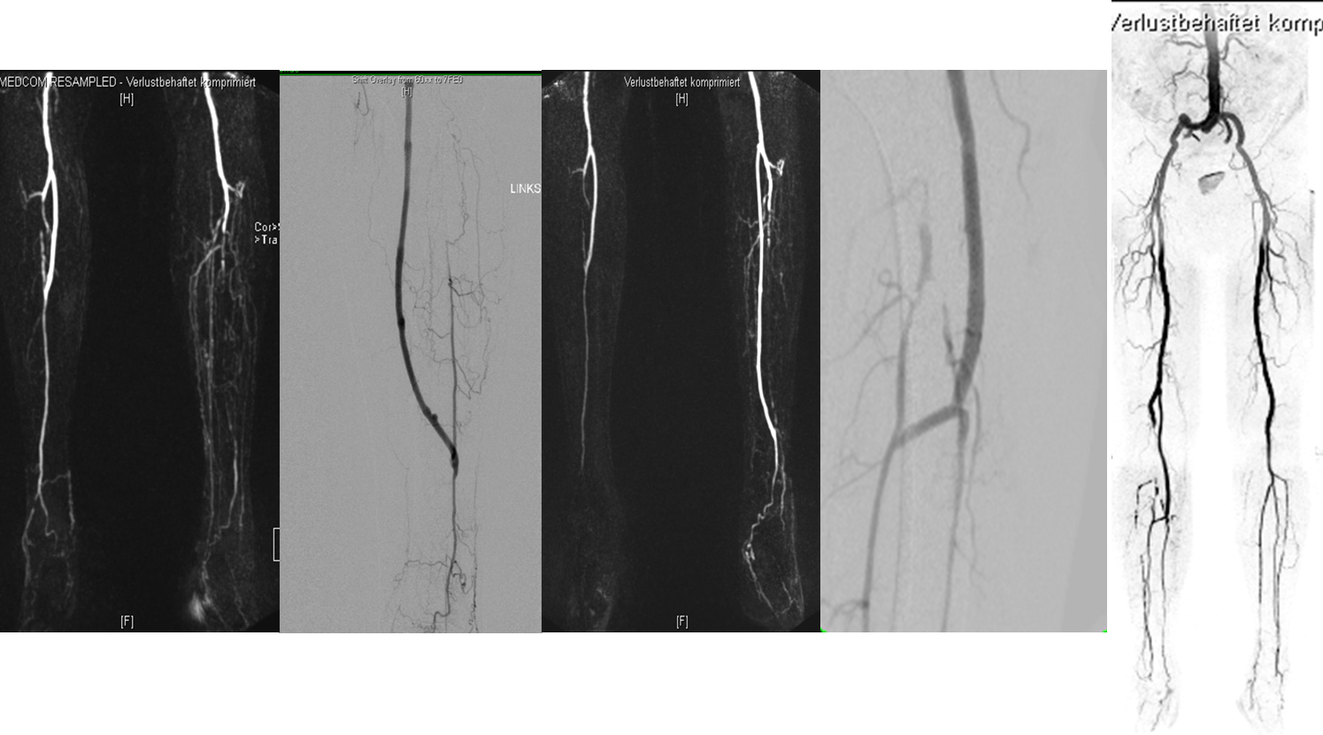 PAVK (Beindurchblutungsstörungen) - Barmherzige Brüder Linz