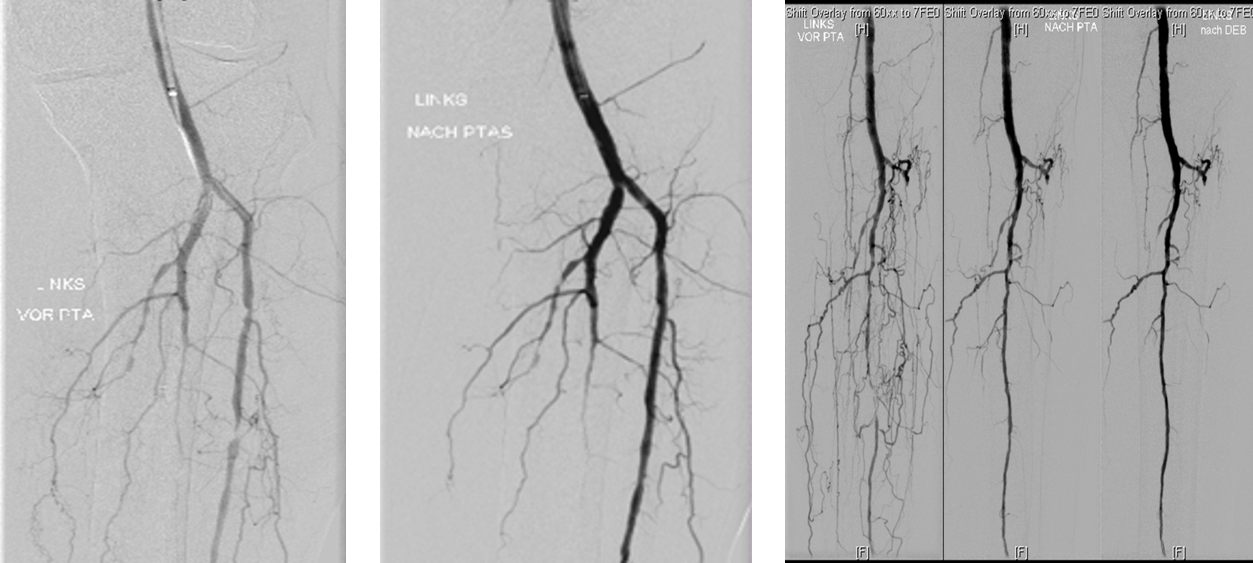 PAVK (Beindurchblutungsstörungen) - Barmherzige Brüder Linz