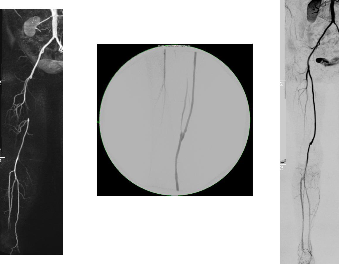 PAVK (Beindurchblutungsstörungen) - Barmherzige Brüder Linz